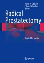 Radical Prostatectomy: Surgical Perspectives | SpringerLink