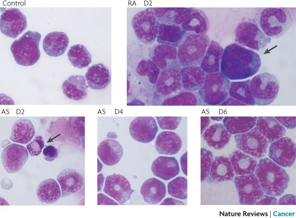 Acute Promyelocytic Leukemia