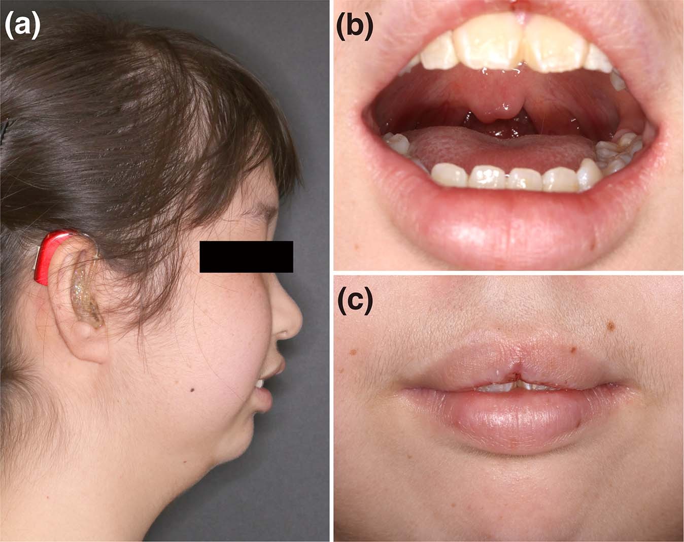 Neurofibromatosis Type 2 Chromosome 22