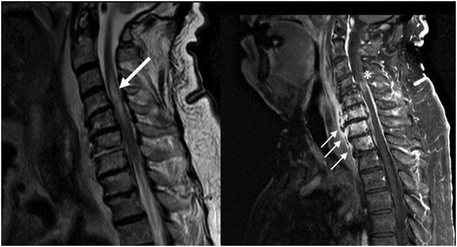 Transverse Myelitis Transverse Myelitis Neurology Medbullets Step