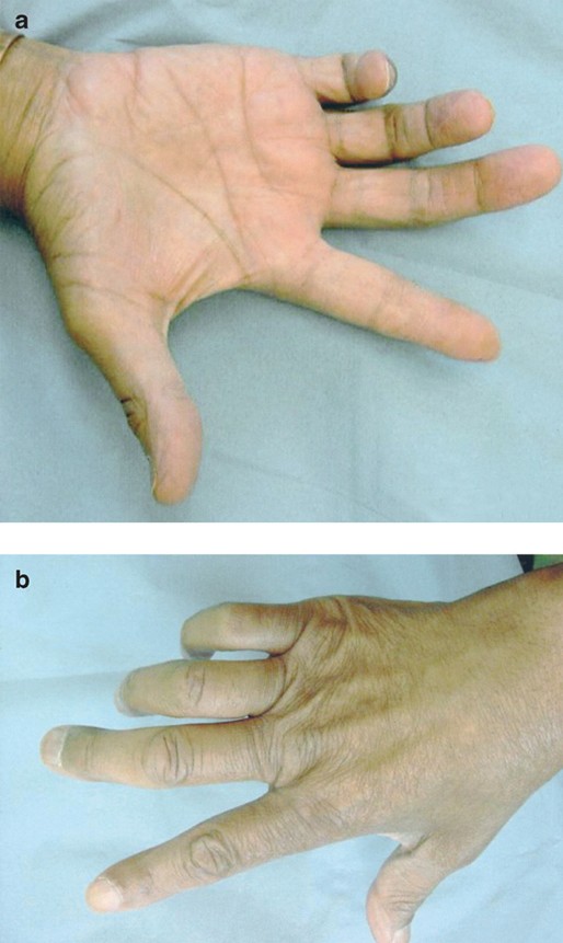 Ulnar Nerve Injury Claw Hand