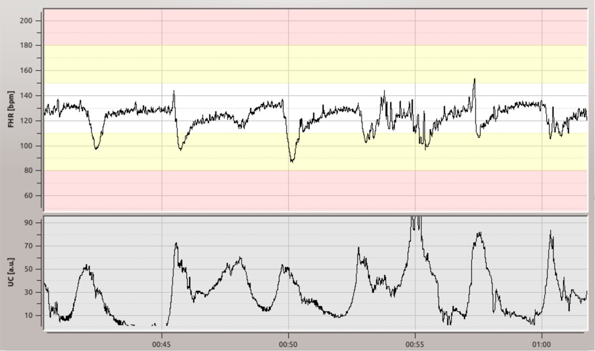 Open access intrapartum CTG database | BMC Pregnancy and Childbirth ...