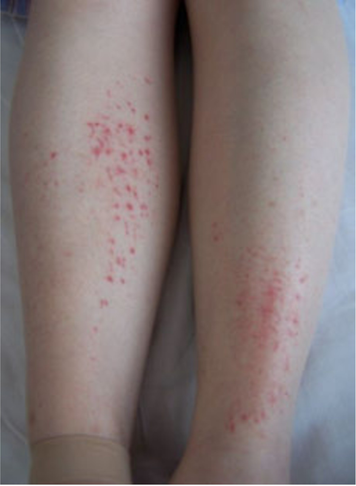 Higher rate of skin rash in a phase II trial with weekly nanoparticle ...