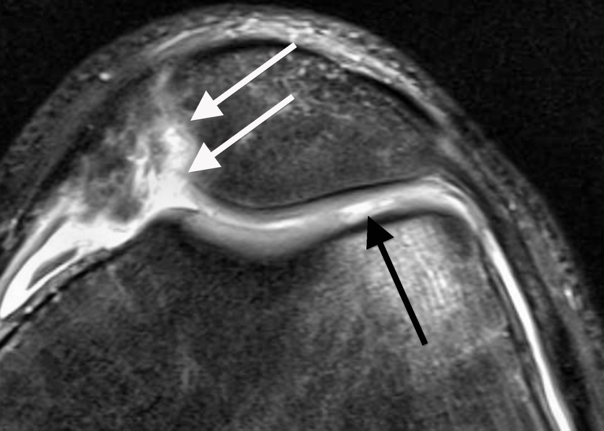 How reliable is MRI in diagnosing cartilaginous lesions in patients ...