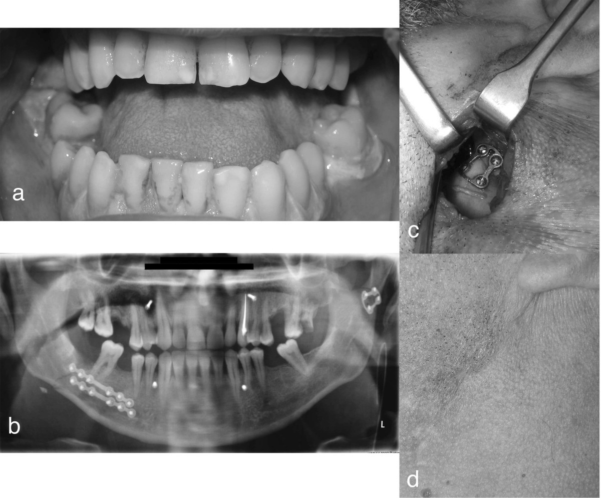 Open reduction and internal fixation of extracapsular mandibular ...