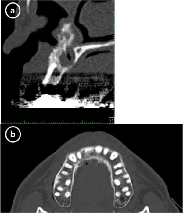 Aesthetic recovery of alveolar atrophy following autogenous onlay bone ...