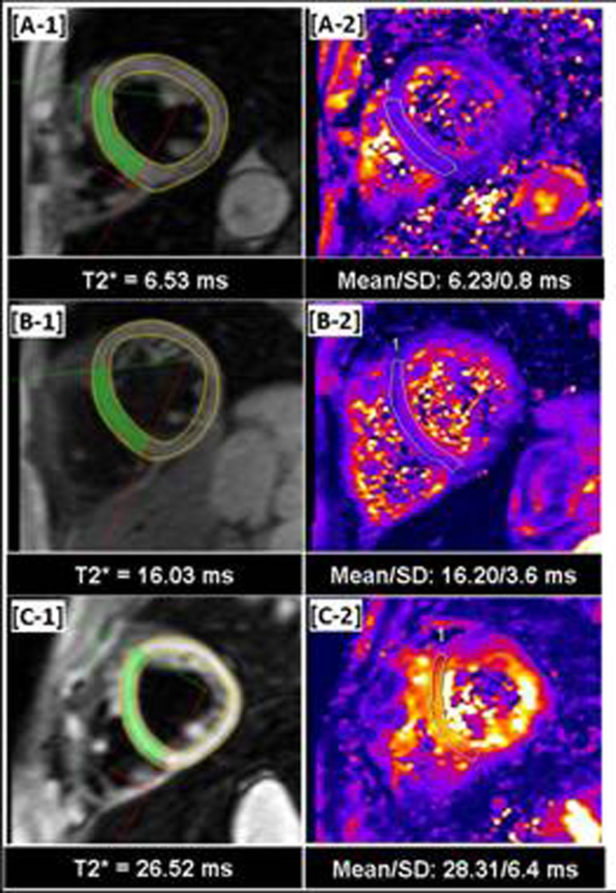 Inline myocardial t2* mapping with iterative robust fitting | Journal of Cardiovascular Magnetic ...