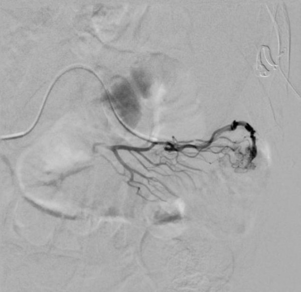 Methylene Blue injection via superior mesenteric artery microcatheter ...