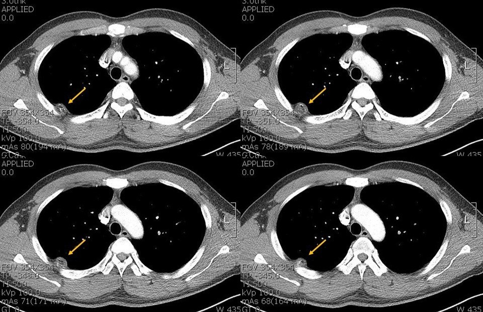 Well-circumscribed type of intramuscular lipoma in the chest wall ...
