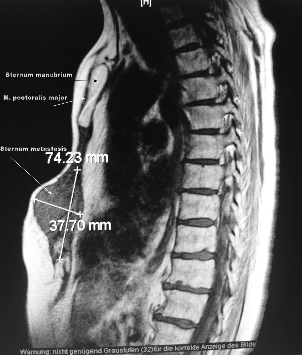Solitary metastatic adenocarcinoma of the sternum treated by total ...