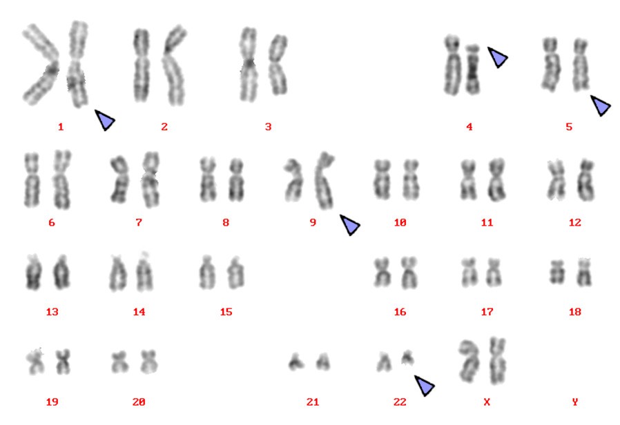 Novel complex translocation involving 5 different chromosomes in a ...