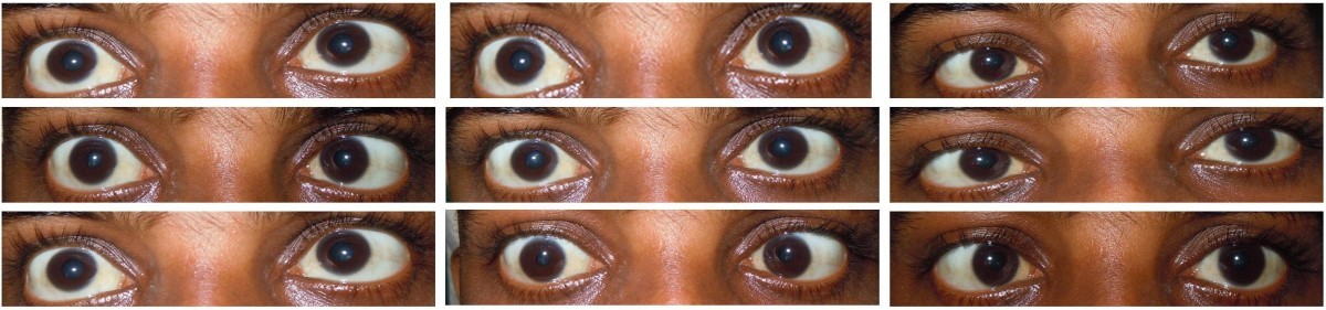 Cryptococcal meningitis presenting with bilateral complete ...