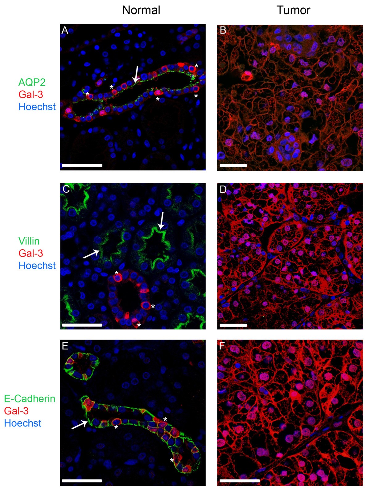 Changes in the expression and subcellular distribution of galectin-3 in ...