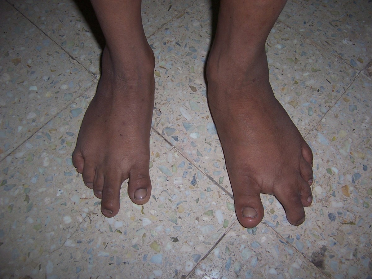 Silver-Russell Syndrome: A Case Report | Cases Journal | Full Text