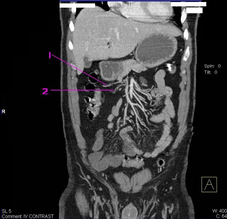 Isolated ileocolic artery occlusion presented with segmental bowel ...