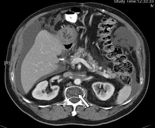 Post radiation chylous ascites: a case report | Cases Journal | Full Text