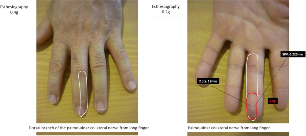 Third degree formic acid chemical burn in the treatment of a hand wart ...