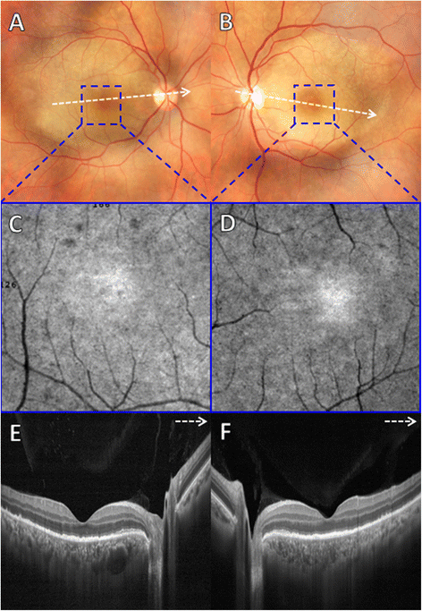 Multimodal imaging analyses of hyperreflective dot-like lesions in ...