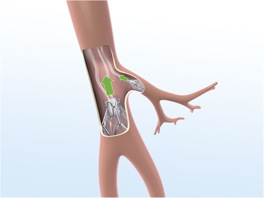 Anaesthetic management for endobronchial valve insertion: lessons ...
