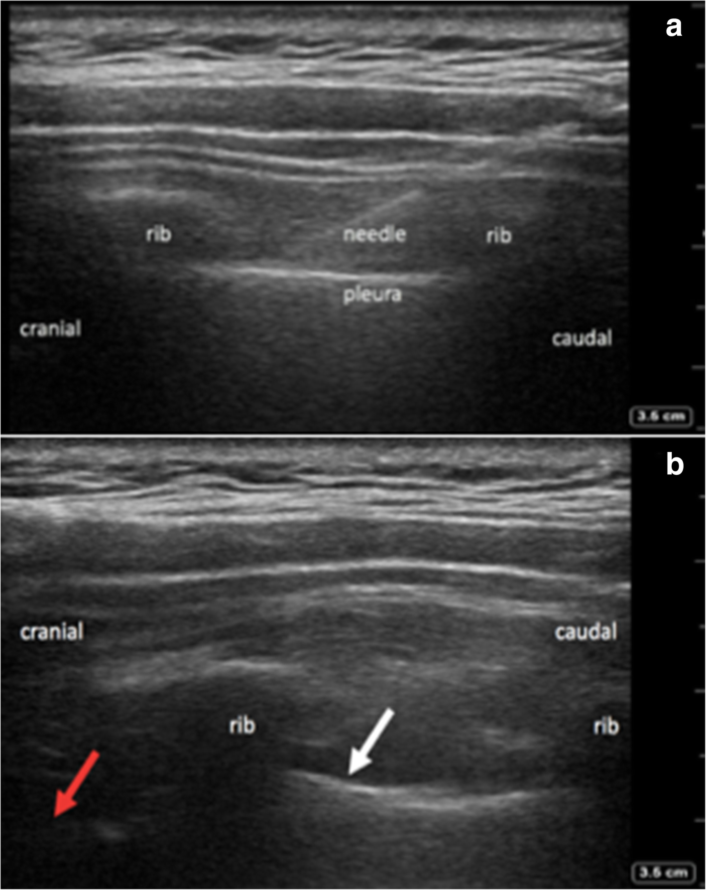 The ultrasound-guided proximal intercostal block: anatomical study and ...
