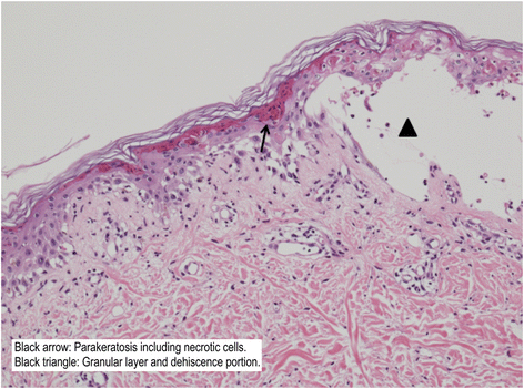 Warfarin-induced toxic epidermal necrolysis in combination therapy of ...