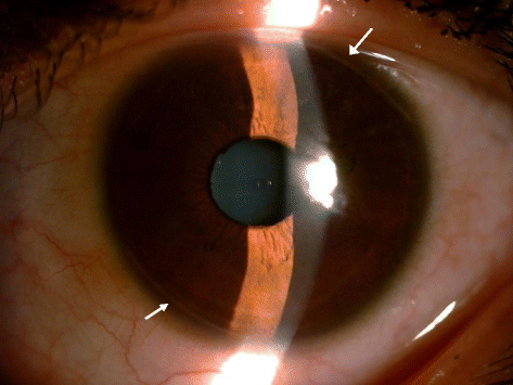 Effect of Limbal relaxing incisions during implantable collamer lens ...
