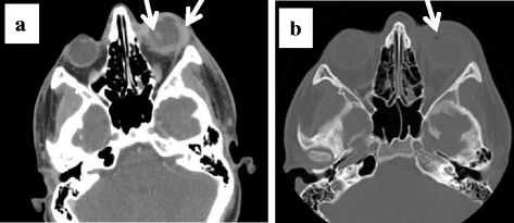 Clostridium perfringens panophthalmitis and orbital cellulitis: a case ...