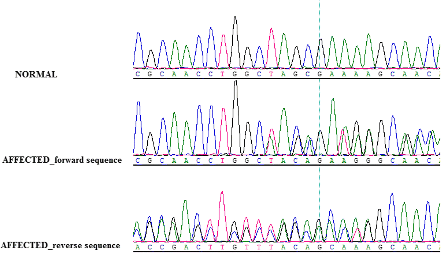Identification of a novel PAX6 mutation in a Chinese family with ...