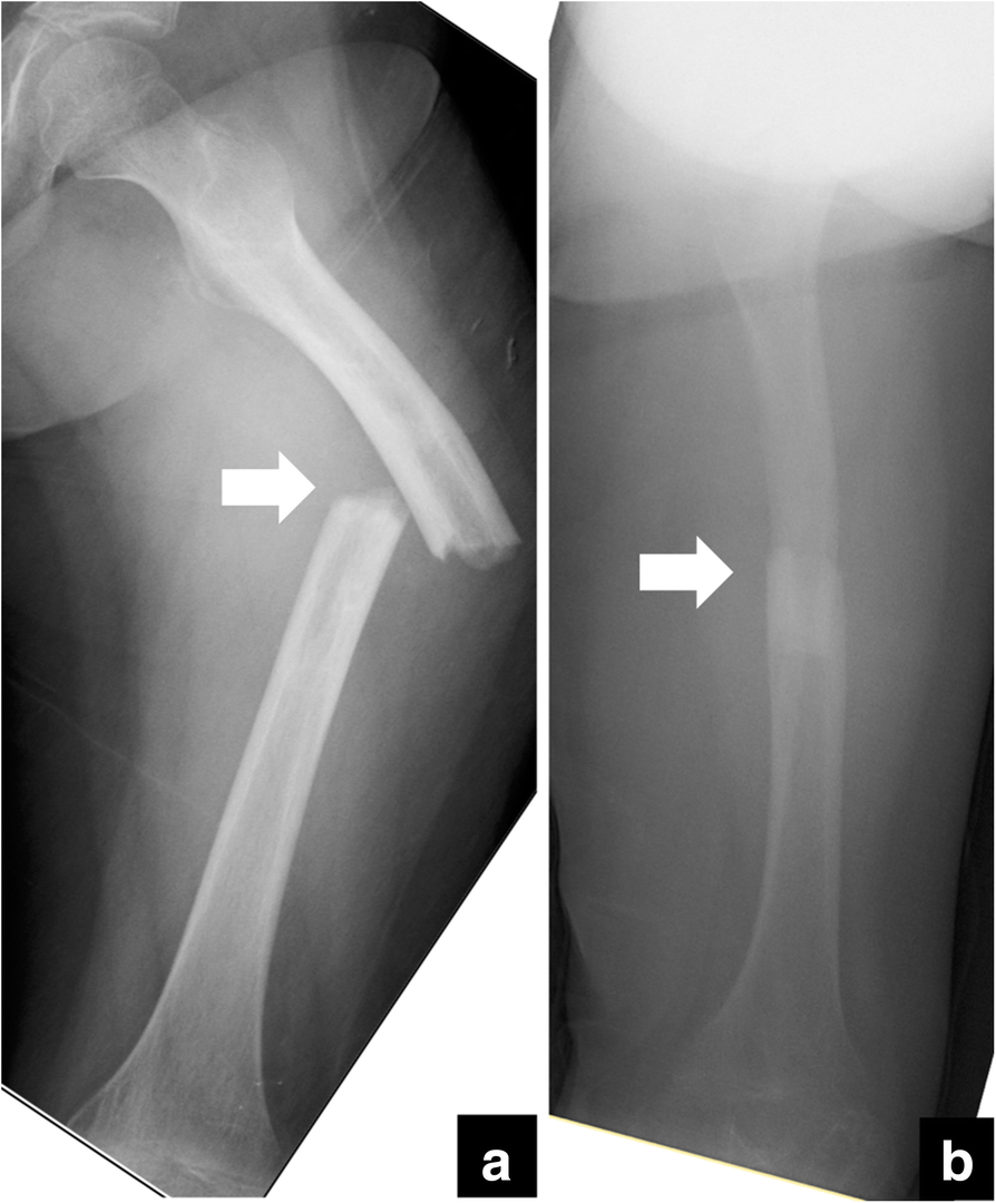 Recurrent femoral shaft fractures in a child with gnathodiaphyseal ...