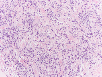 Cellular angiofibroma in women: a review of the literature | Diagnostic ...