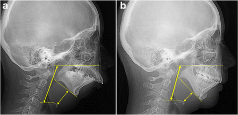 Micrognathia with temporomandibular joint ankylosis and obstructive ...