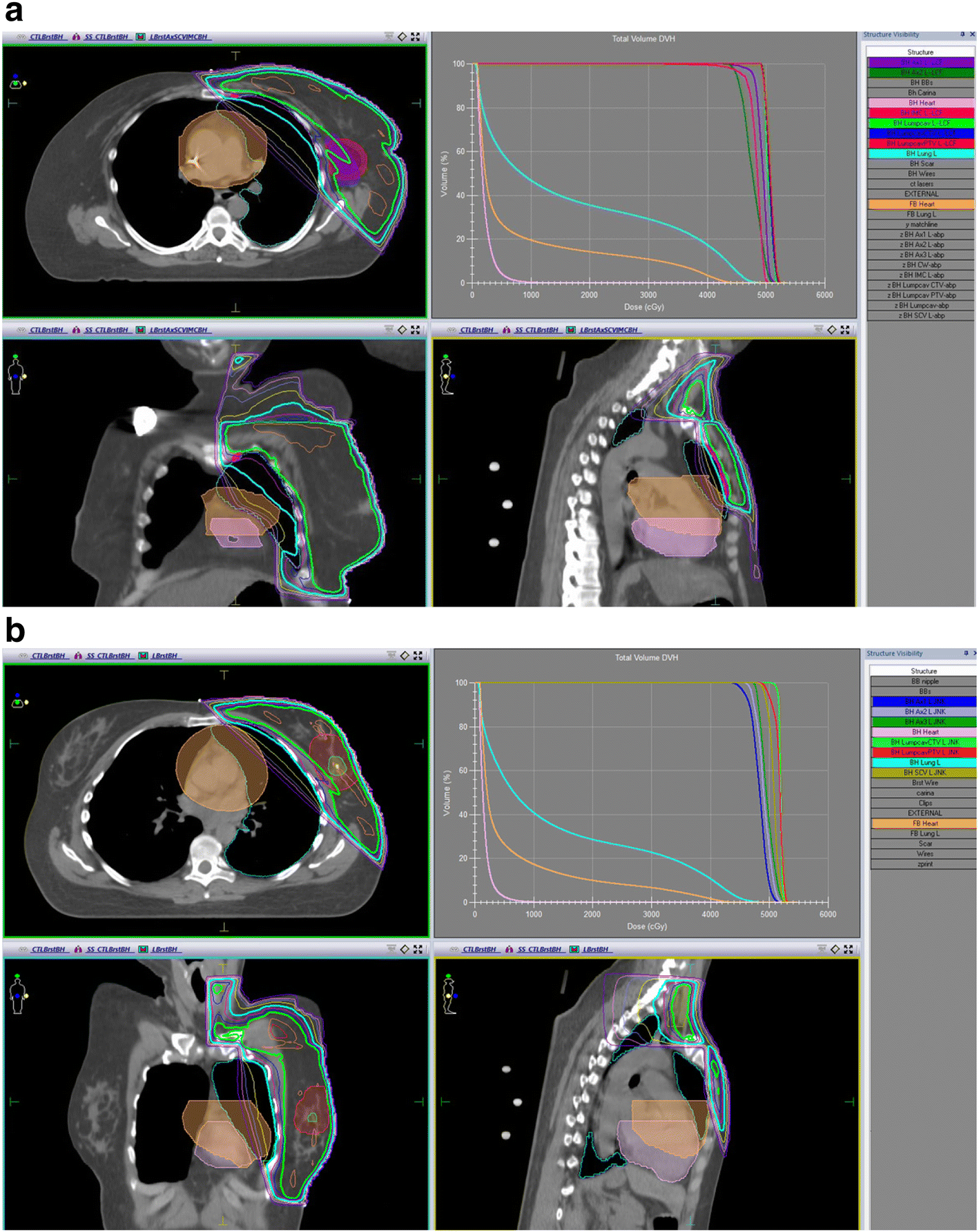 Cardiac sparing characteristics of internal mammary chain radiotherapy ...