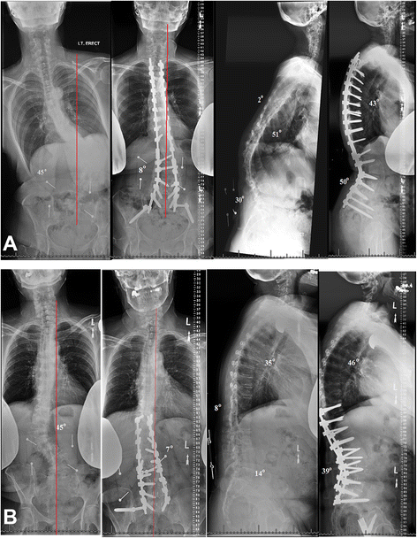 Three-column osteotomy surgery versus standard surgical management for ...