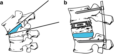 Pedicle subtraction osteotomy and disc resection with cage placement in ...