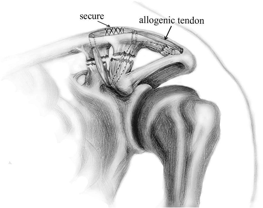 Treatment of AC dislocation by reconstructing CC and AC ligaments with ...