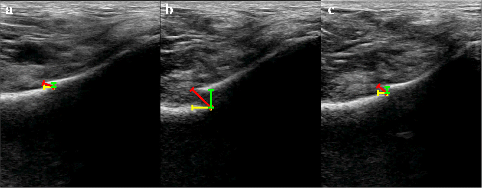 Use of ultrasonography for evaluation of stability of lateral ...