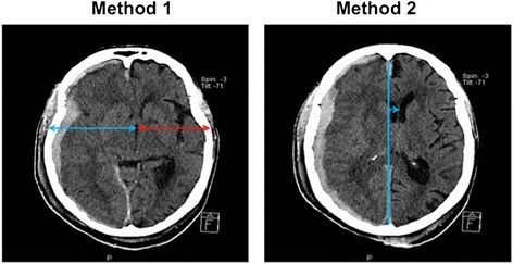 Assessment of brain midline shift using sonography in neurosurgical ICU ...