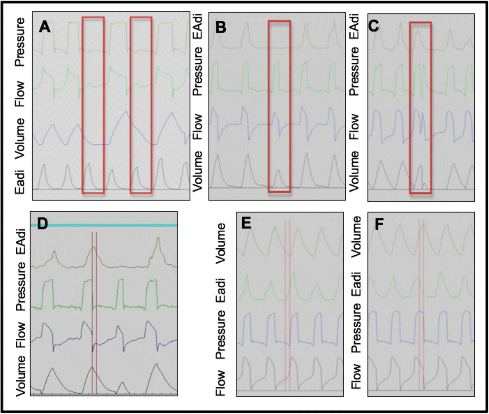 Neurally adjusted ventilatory assist (NAVA) versus pressure support ...