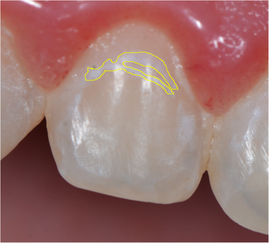 Effectiveness of an antibacterial primer used with adhesive-coated ...