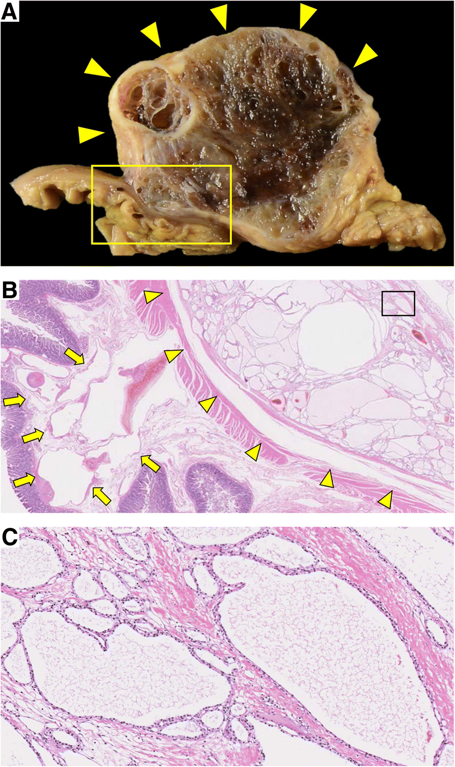 A case of duodenal hemorrhage due to arteriovenous malformation around ...
