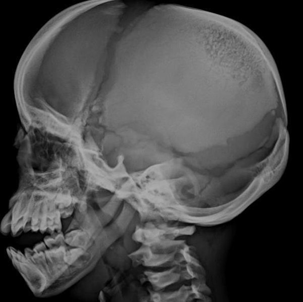 Pycnodysostosis with unusual findings: a case report | Cases Journal ...