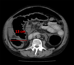 Konservative und operative Therapie des Ileus | SpringerLink
