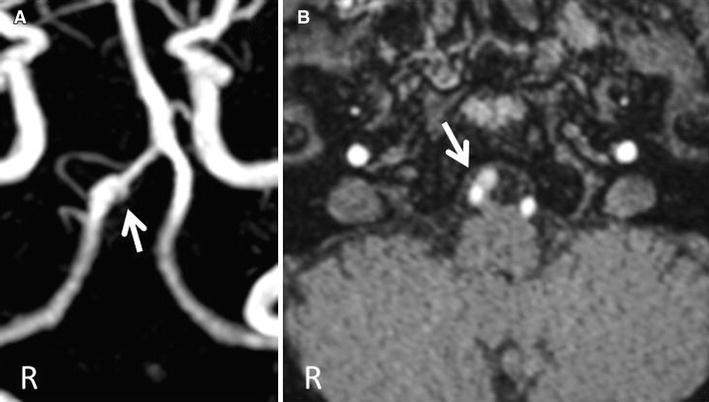 Spontaneous cervicocephalic arterial dissection with headache and neck ...