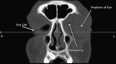 Orbital compartment syndrome from retrobulbar hemorrhage | SpringerLink