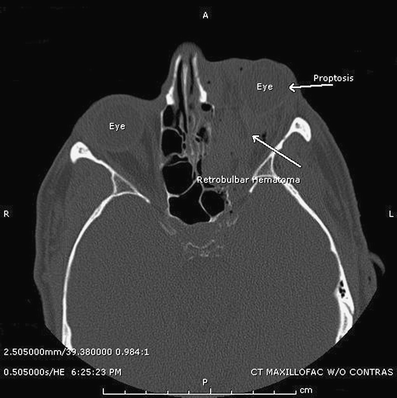 Orbital compartment syndrome from retrobulbar hemorrhage | SpringerLink