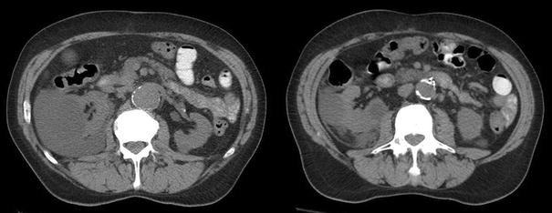 Emergency ultrasound diagnosis of traumatic renal cyst rupture | The ...
