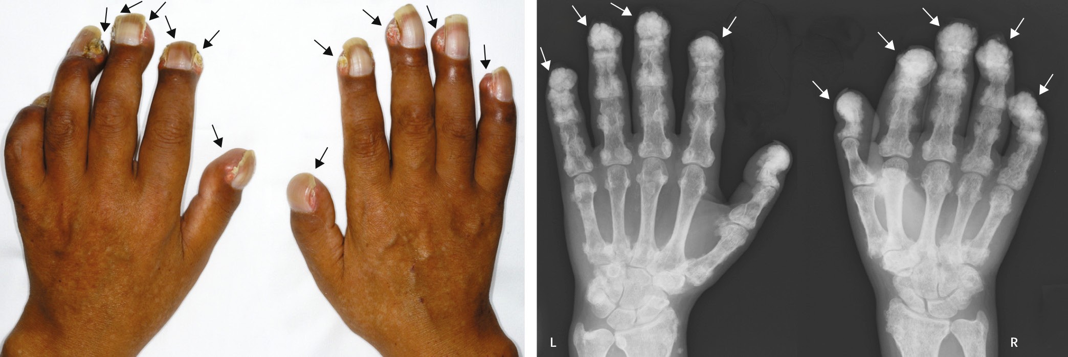 Verkalkte Knoten an allen Fingerspitzen | SpringerLink