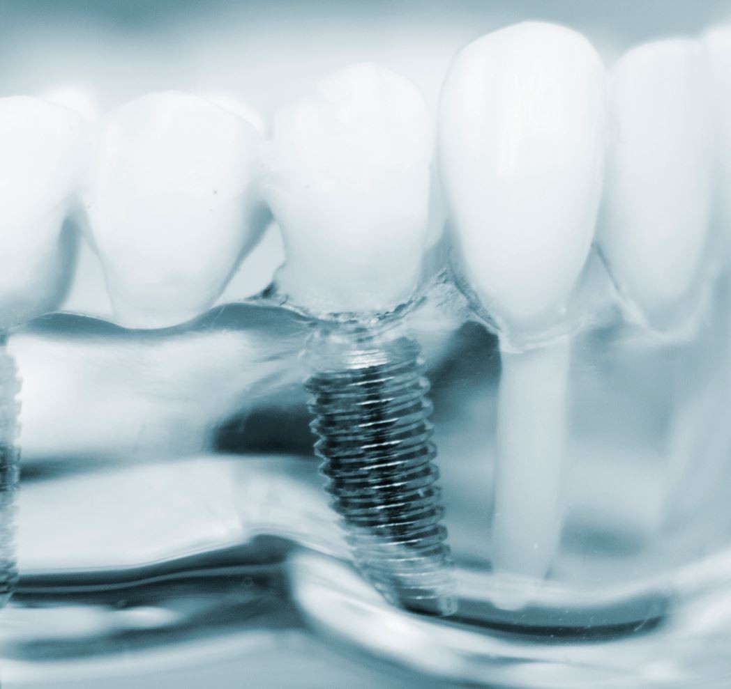 NHS-funded implants: are they as common as they seem? | British Dental ...