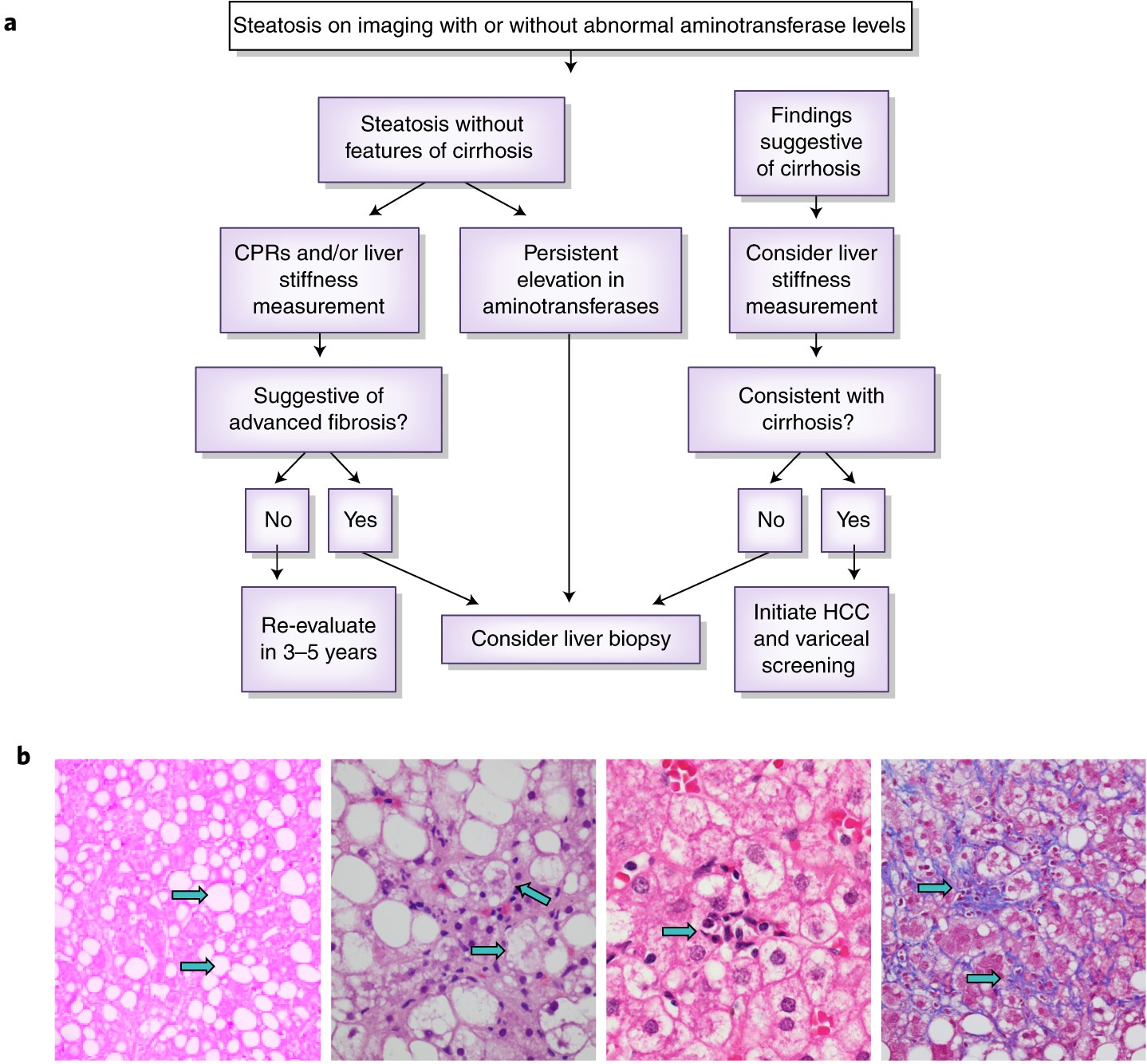 Mechanisms of NAFLD development and therapeutic strategies | Nature ...