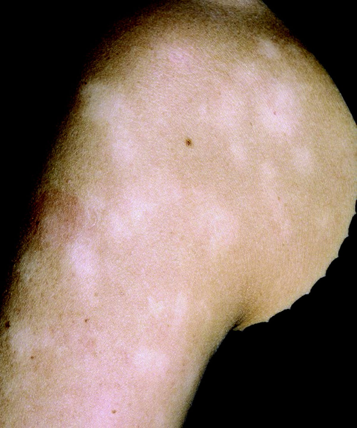 Dermatology for the Allergist | World Allergy Organization Journal ...